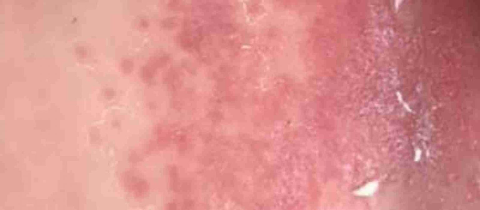 Can Hand Foot and Mouth Cause Diaper Rash? - Raising Families Naturally